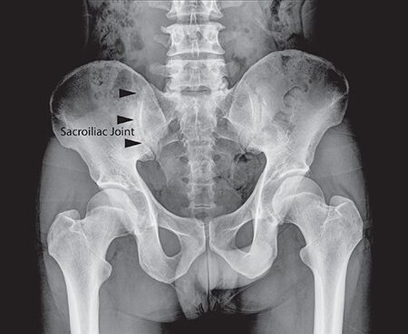 Sacrum Pain