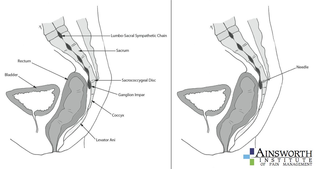 Ganglion of Impar Block - Ainsworth Institute